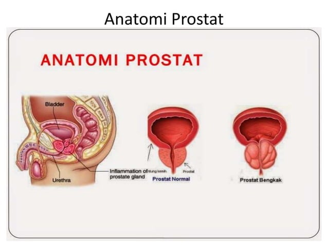Askep Benigna Prostat Hiperplasia (BPH).pptx