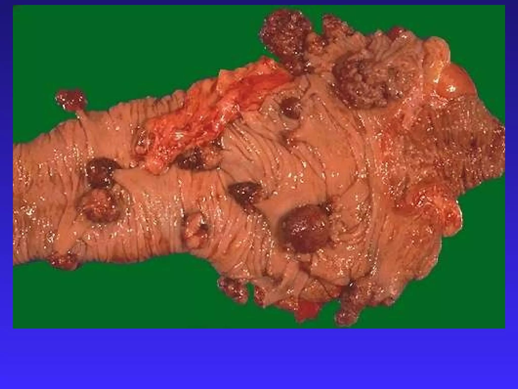 Askep ca colon inggris | PPT
