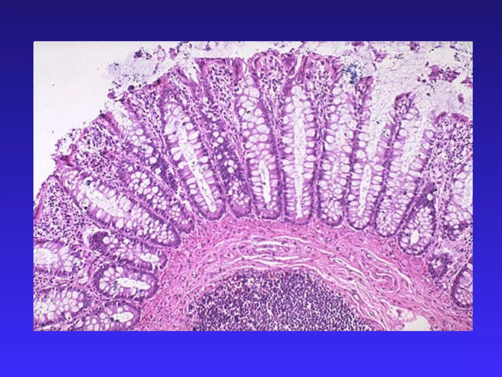 Askep ca colon inggris | PPT