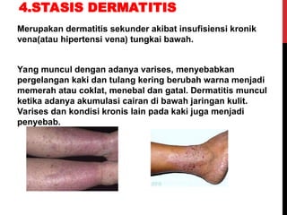 Asuhan keperawatan pada pasien dengan Dermatitis.ppt
