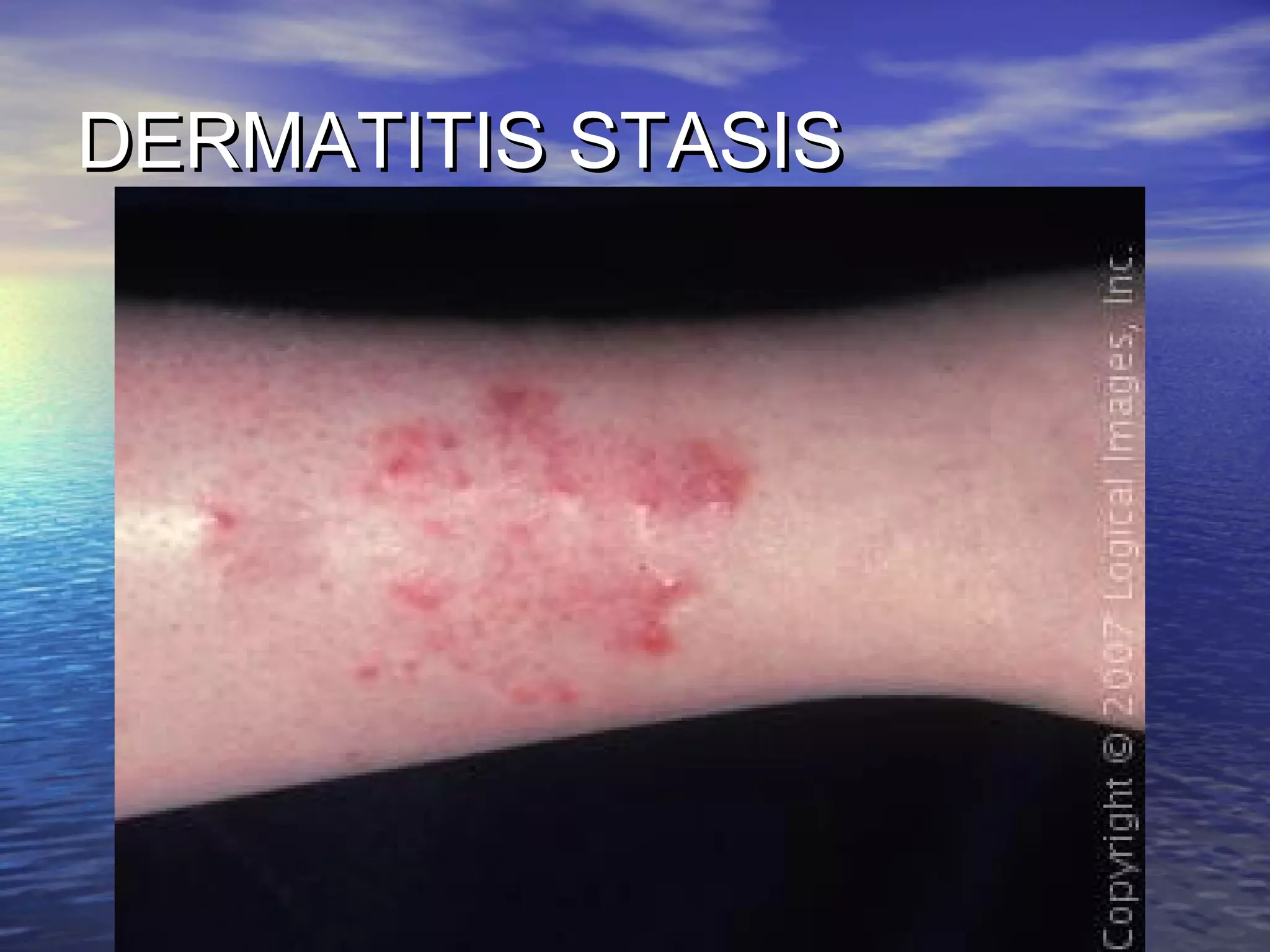 Askep dermatitis atau eksema | PPT
