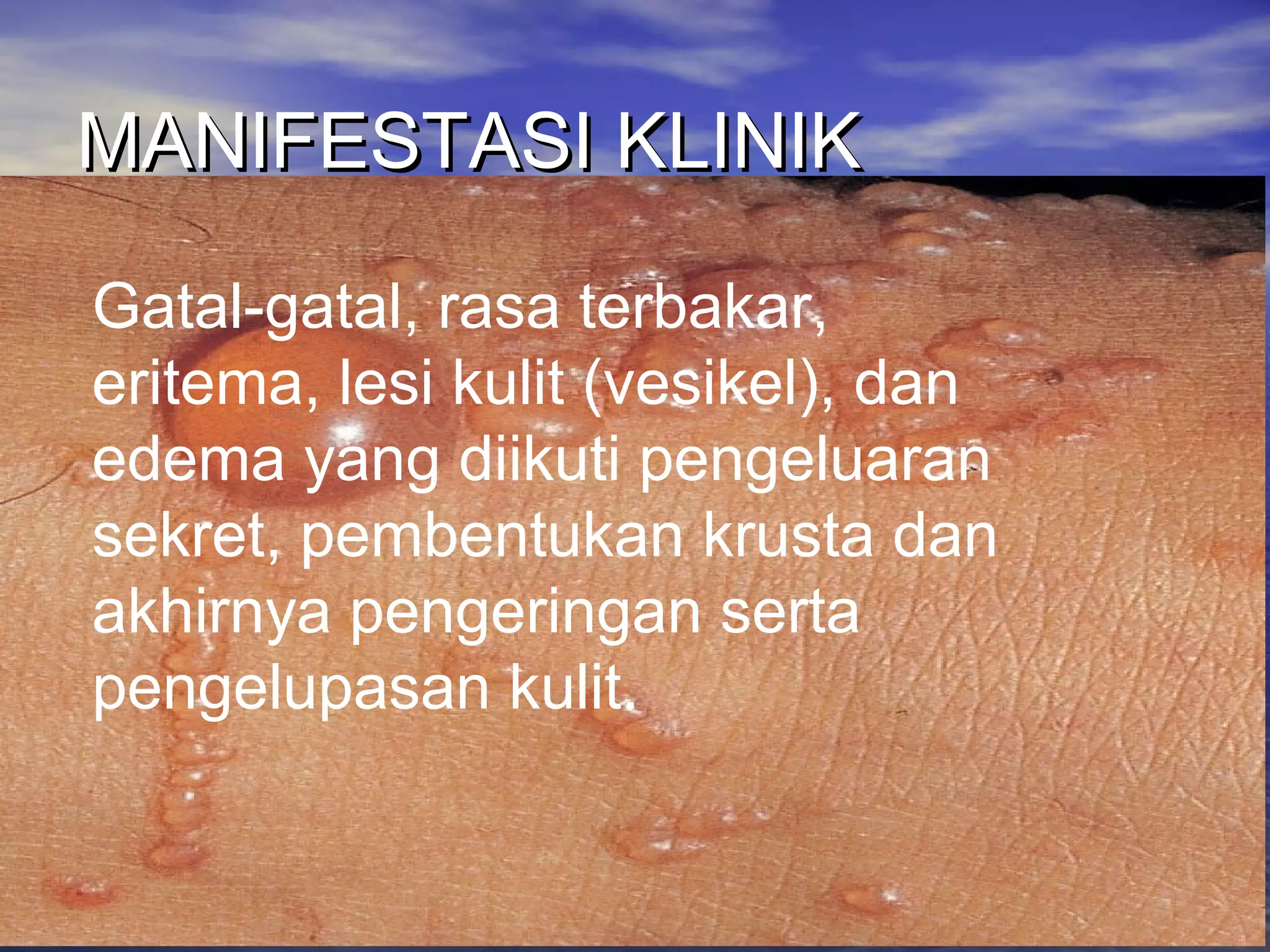 Askep dermatitis atau eksema | PPT
