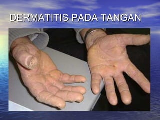 Askep dermatitis atau eksema | PPT