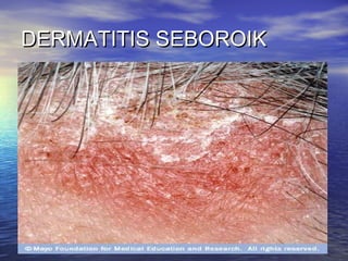 Askep dermatitis atau eksema | PPT