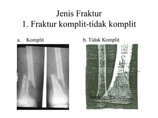 Askep fraktur | PPT
