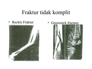 Askep fraktur | PPT