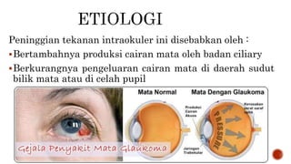 Askep glaukoma.pptx