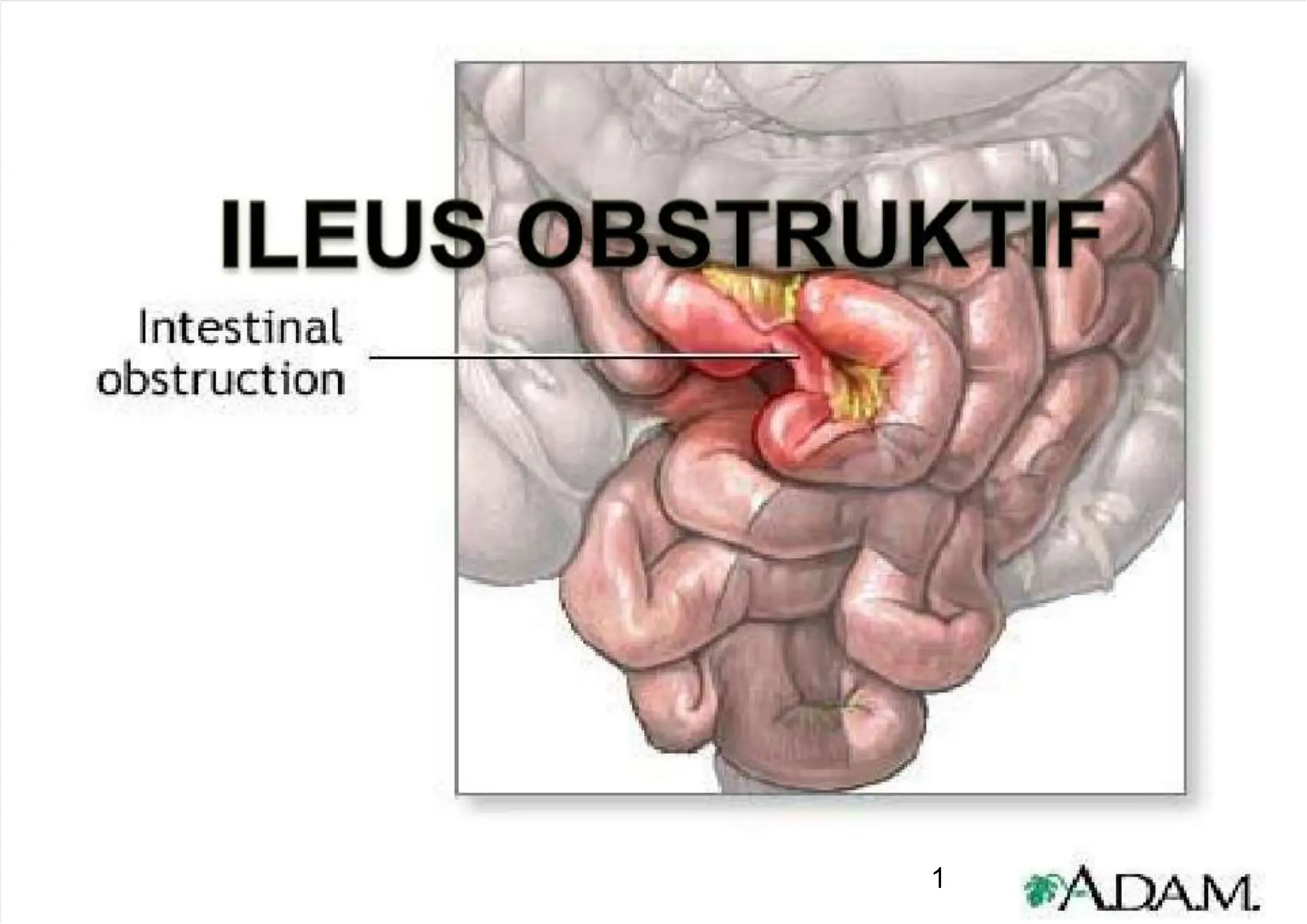 Askep Ileus Obstruksi.pdf