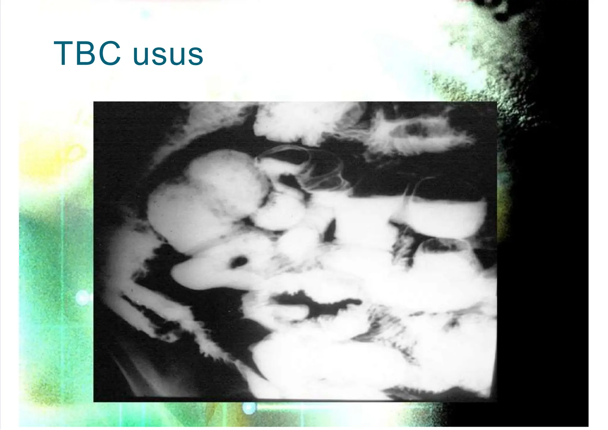 Askep Ileus Obstruksi.pdf