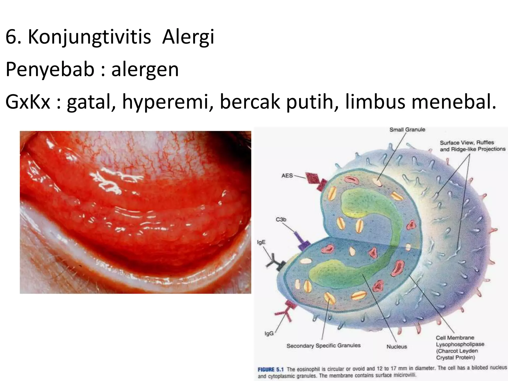 Askep konjungtivitis as | PPTX