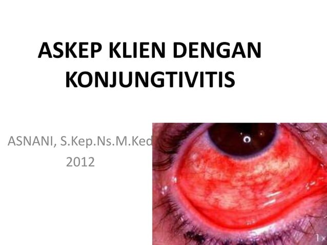 Askep konjungtivitis as | PPT