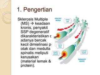 Askep multiple sklerosis | PPTX