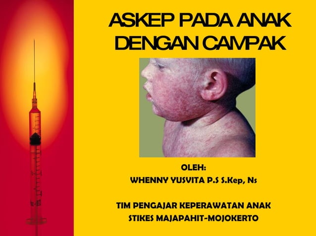Askep pada anak dengan campak | PPT
