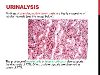 ACUTE KIDNEY INJURY AKI laboratory investigation | PPTX