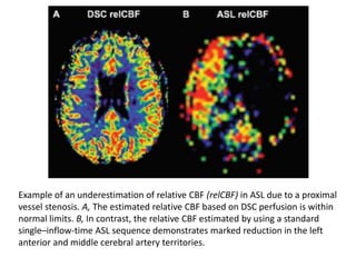 Arterial Spin Labelling in stroke | PPTX