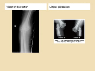 Elbow Fracture Dislocation