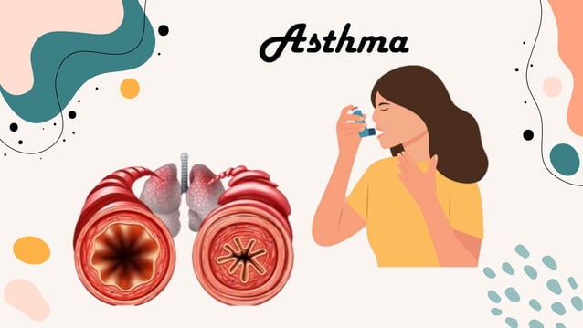Asma.pptx | Lung and Respiratory Health | Diseases and Conditions