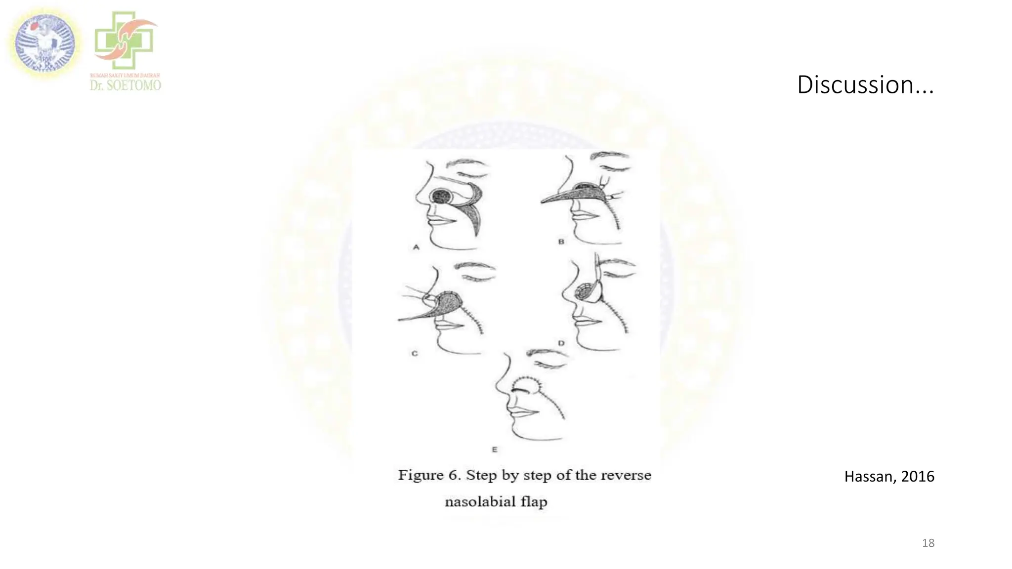 case report nasolabial flap nasal ala recons with reverse nasolabial ...