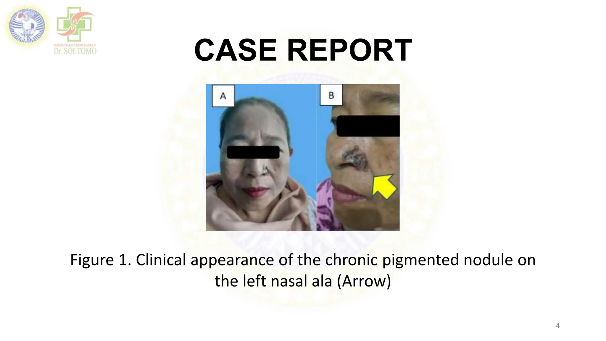 case report nasolabial flap nasal ala recons with reverse nasolabial ...