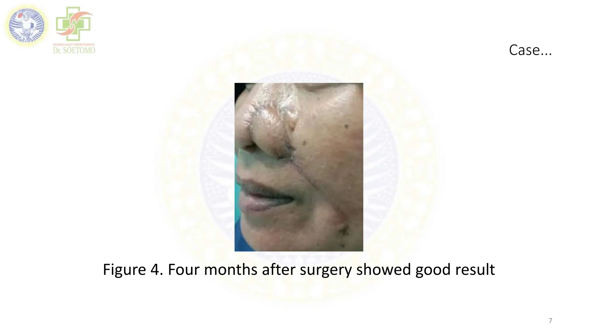 case report nasolabial flap nasal ala recons with reverse nasolabial ...