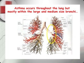 Asma bronkial-ppt | PPT