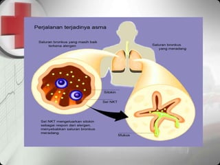 Asma bronkial-ppt | PPT