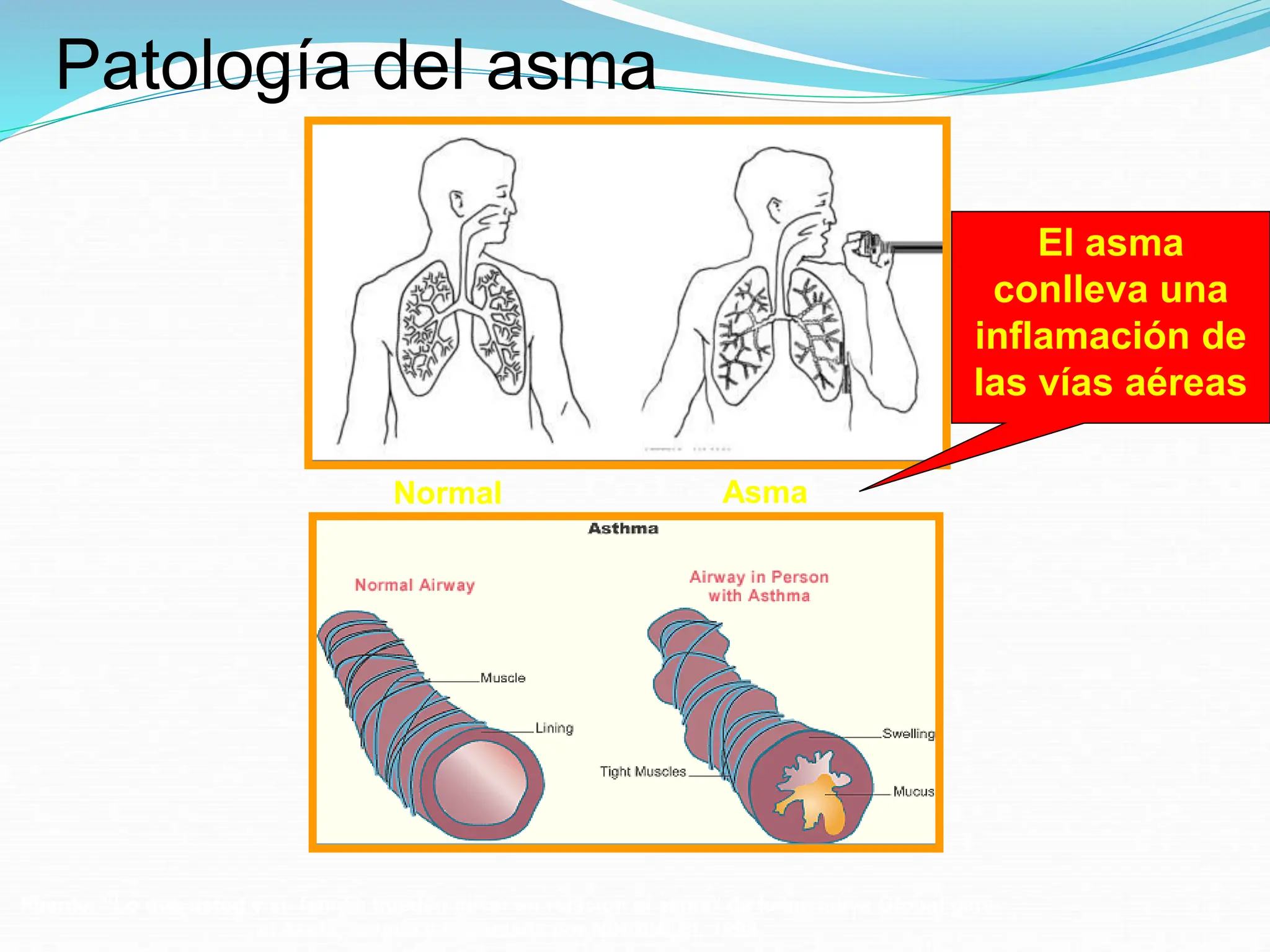 ASMA-BRONQUIAL.ppt diagnóstico y tratamiento | PPT