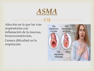 Asma diapositiva | PPTX