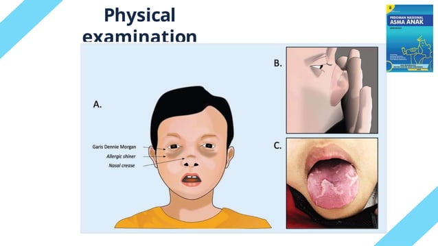 Asma pada anak di fasilitas kesehatan atau tenaga kesehatan | PPT