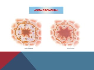Asma bronquial | PPTX