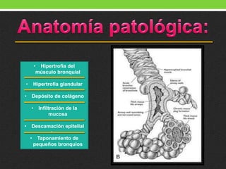 Asma Bronquial Pptx