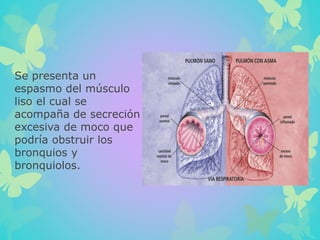 Asma bronquial | PPTX