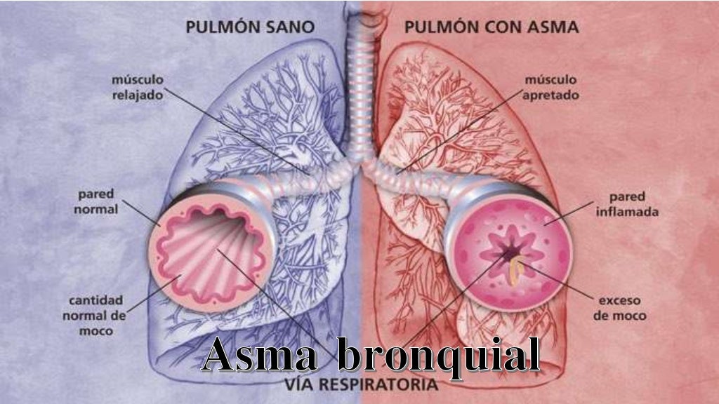 Asma bronquial