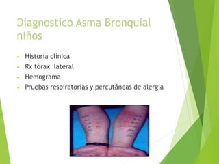 Asma bronquial | PPT