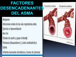 Asma bronquial medicina interna | PPTX