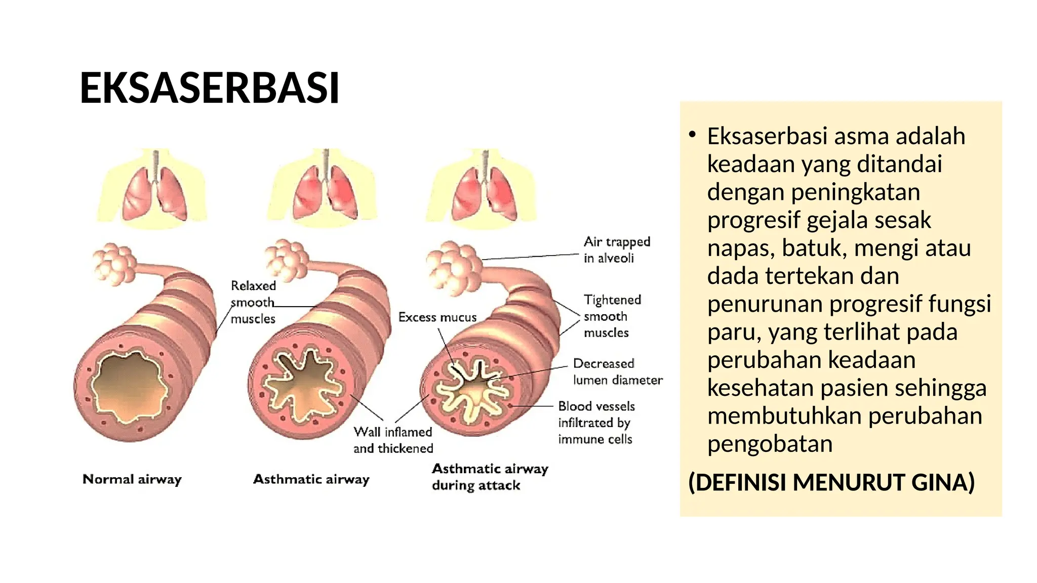 ASMA PADA DEWASA: DIAGNOSIS YANG TEPAT DAN TERAPI YANG EFEKTIF.pptx