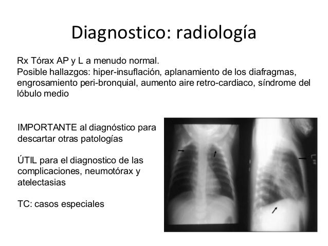 Asma en pediatría