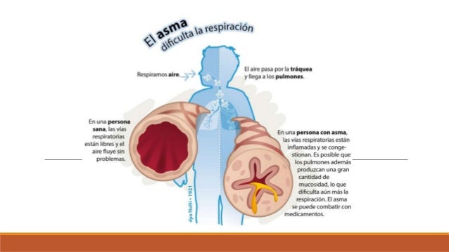 Asma (fisiopatología