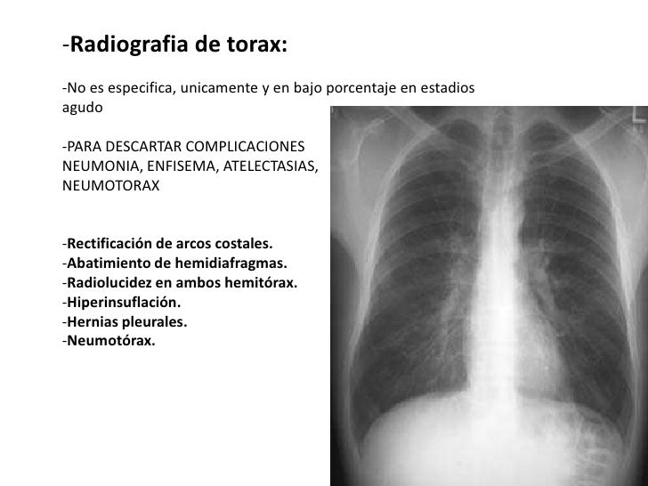 Tratamiento del Asma