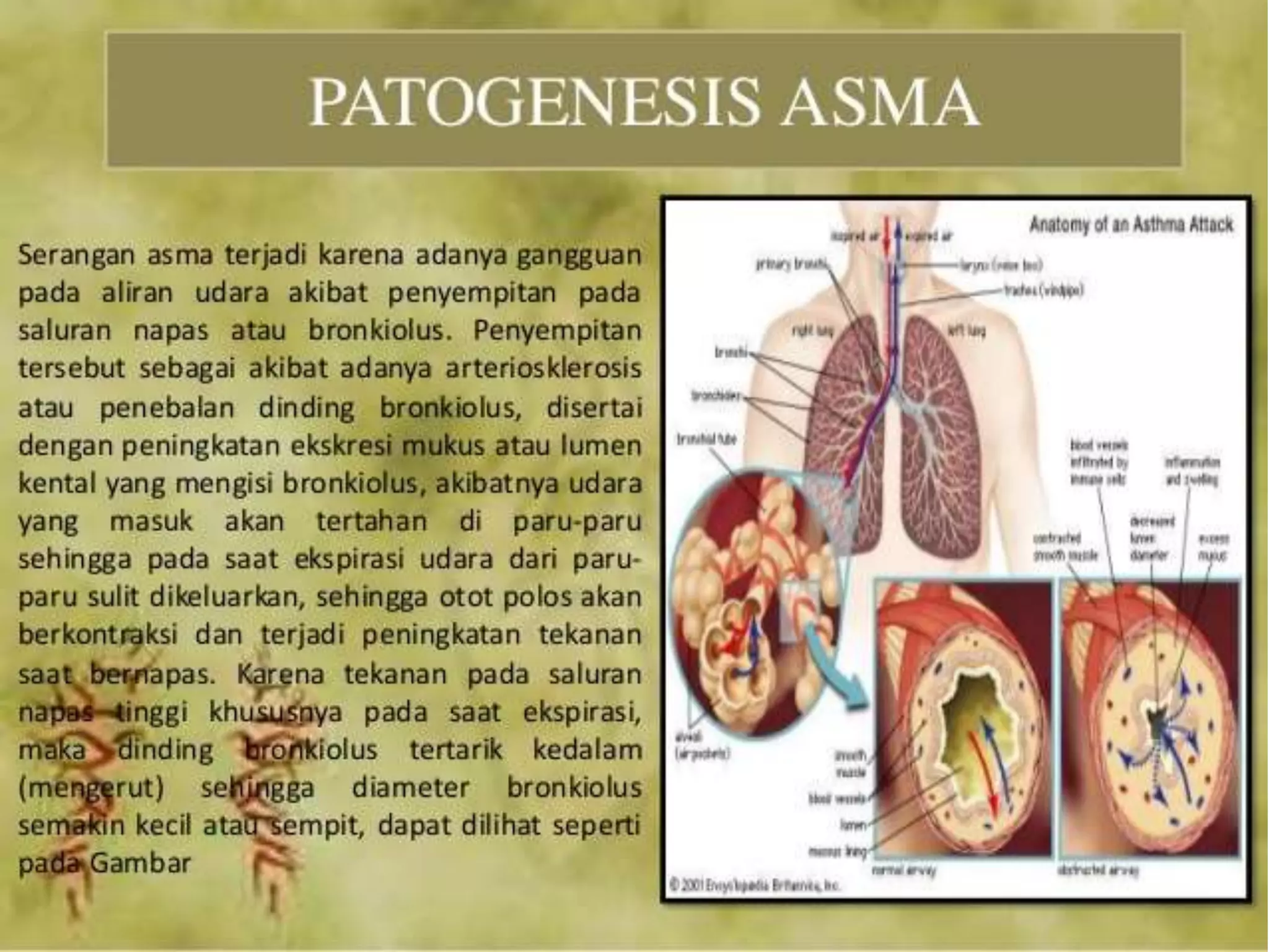 ASMA: patofisiologi Asthma | PPTX