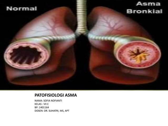 ASMA: patofisiologi Asthma | PPTX