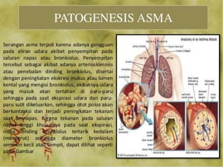ASMA: patofisiologi Asthma | PPTX