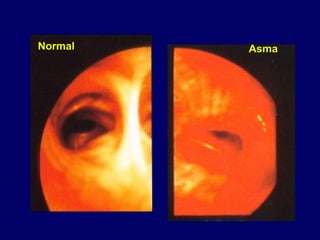 power point tentang asma dan ppok/penyakit paru | PPT