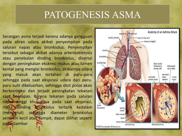 Asma ppt (2) | PPT