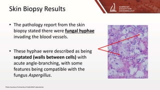 ASM_CPHMC_Case_Study_Study_Invasive-Fungal-Infections-Identification ...
