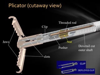 Engineering a New Approach to Mitral Valve Regurgitation: Direct ...