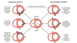 TYPES AND PATTERNS OF MYOCARDIAL INFARCTION.pptx