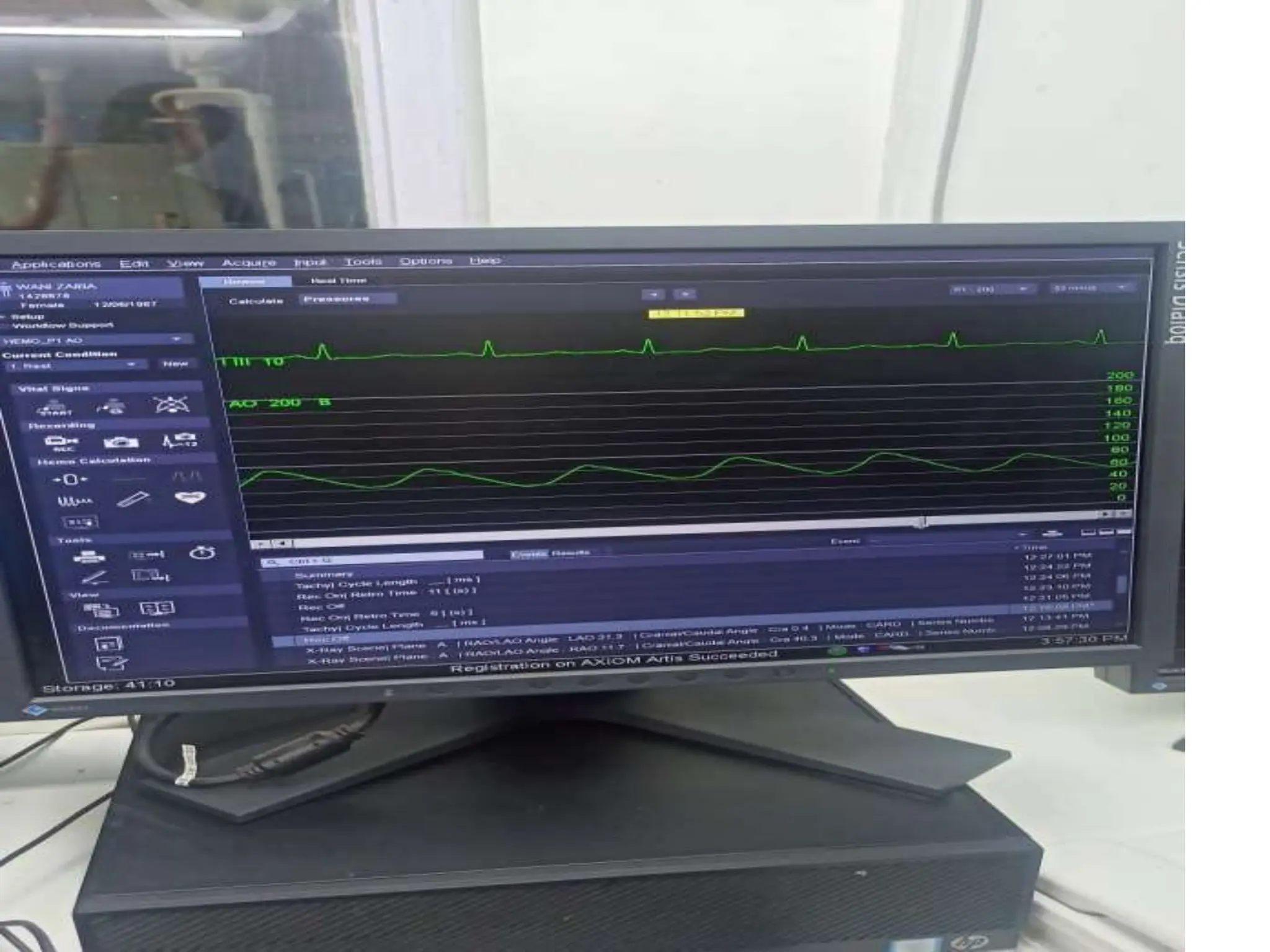 multivalvular heart disease AS, MR WITH PDA.pptx