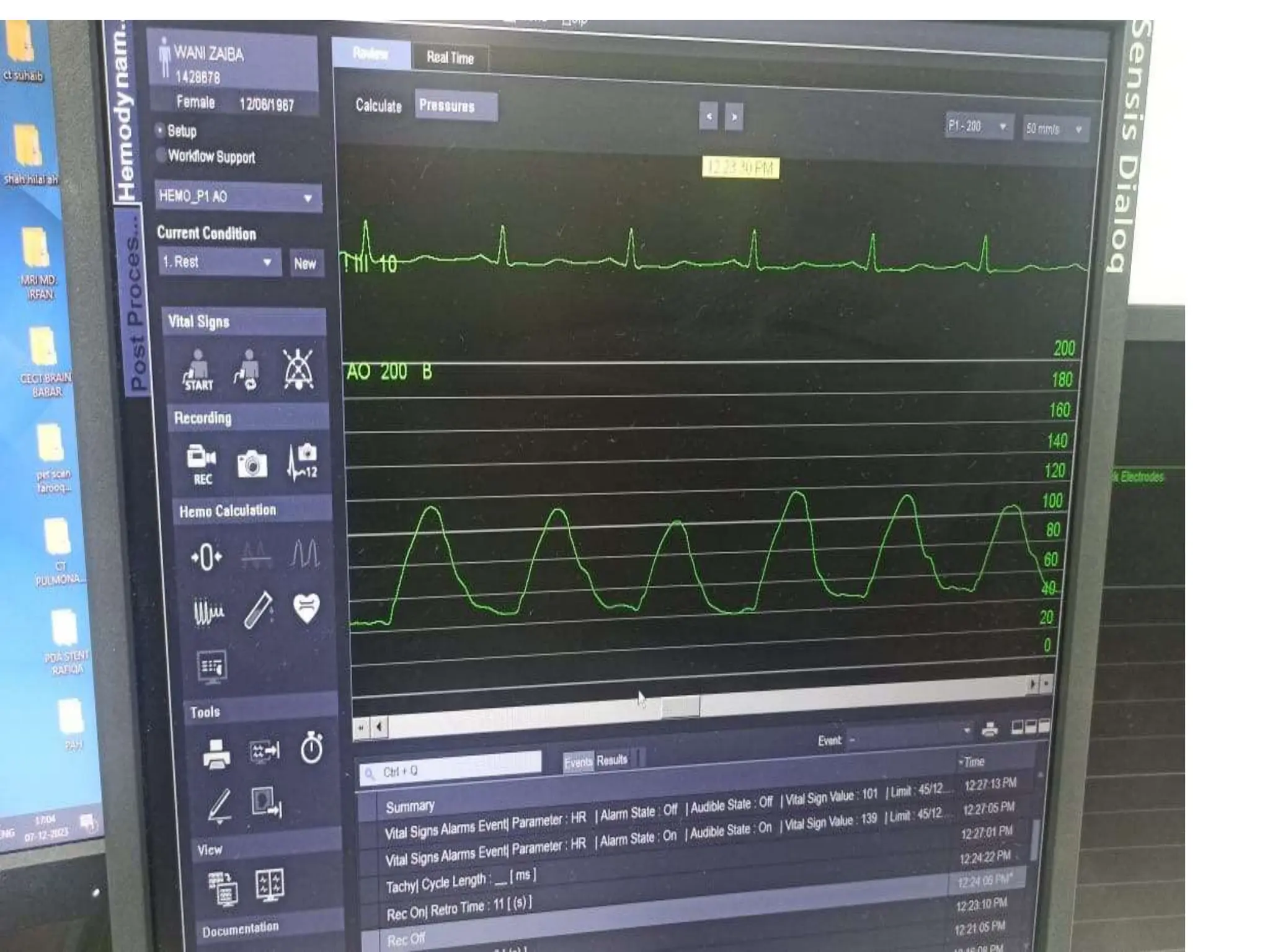multivalvular heart disease AS, MR WITH PDA.pptx