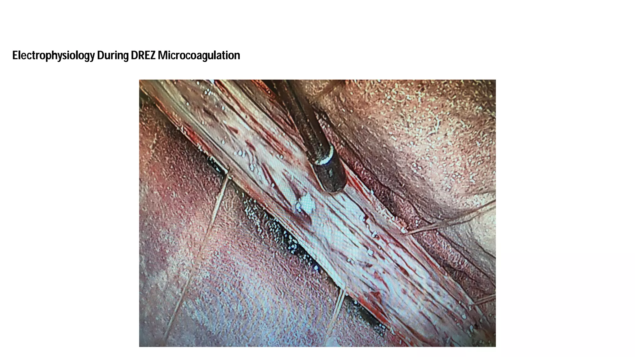 The Role of Electrophysiology During Dorsal Root Entry Zone ...